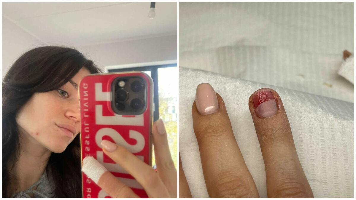 Beta Beidz sakropļojusi roku: “Izskatās pēc zemeņu ievārījuma”